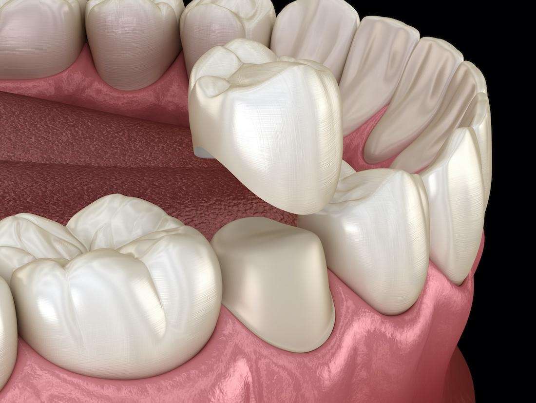 How To Fix A Cracked Tooth Naturally | Dental Crowns and Bridges Encino CA